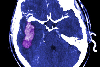 RCPI Diploma in Cerebrovascular & Stroke Medicine 2009/2010