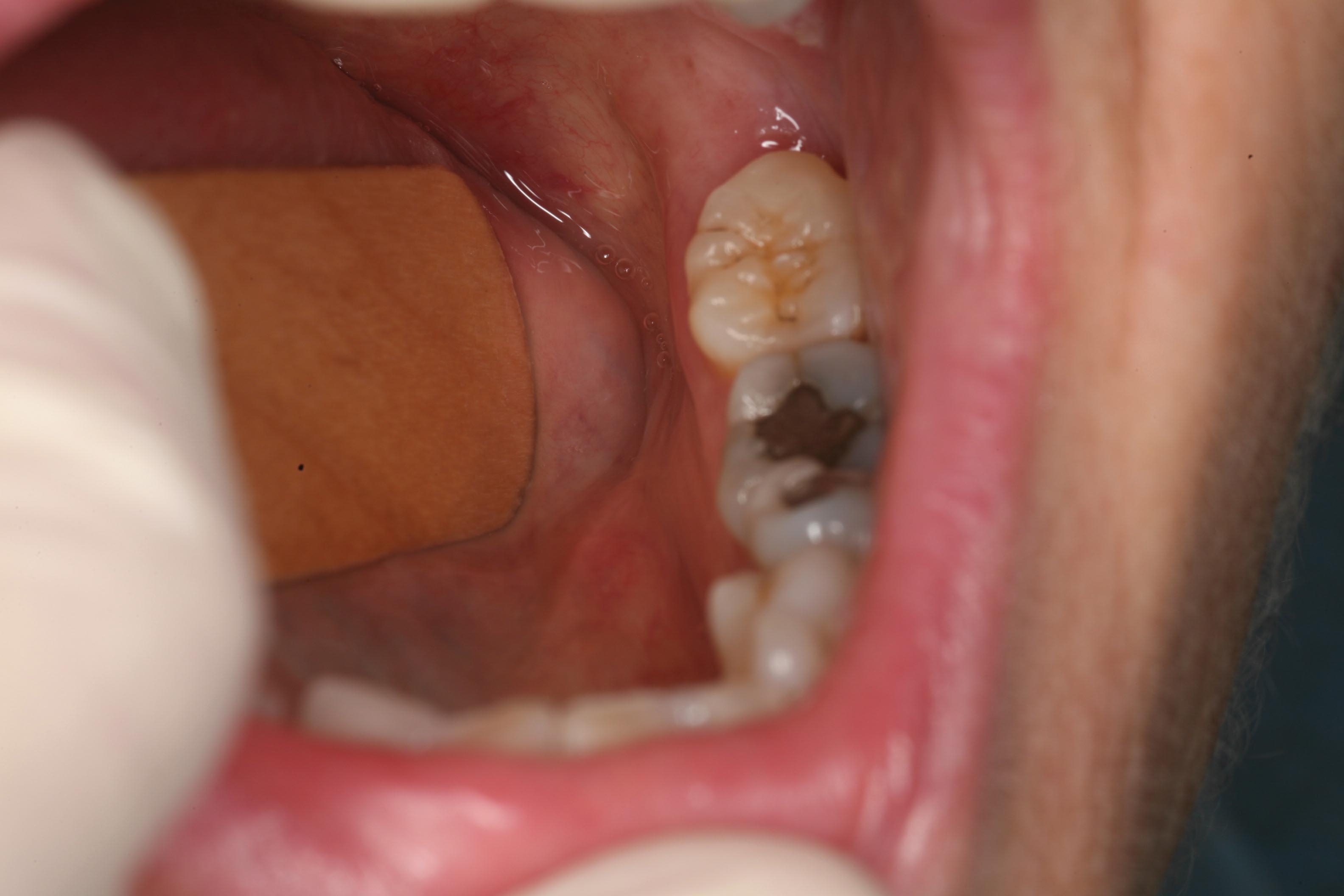 Raising mouth cancer awareness