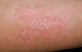 Psychological aspects of psoriasis