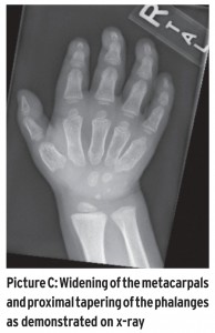 Recognising Hunter syndrome: the diagnosis and investigation