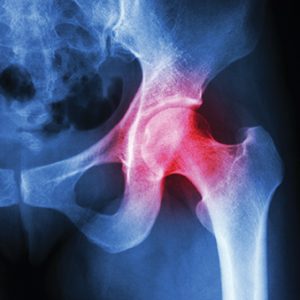 Range of treatments available to manage psoriatic arthritis